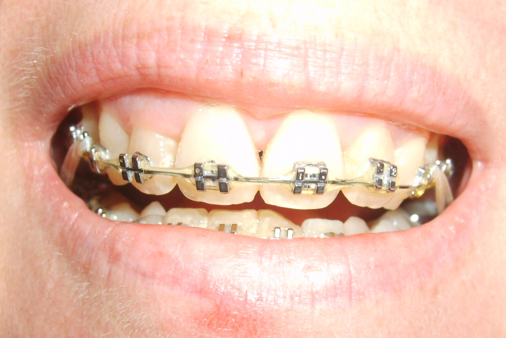 beugel om tanden op hun plaats te houden na vaste beugel | Tandarts.nl ...