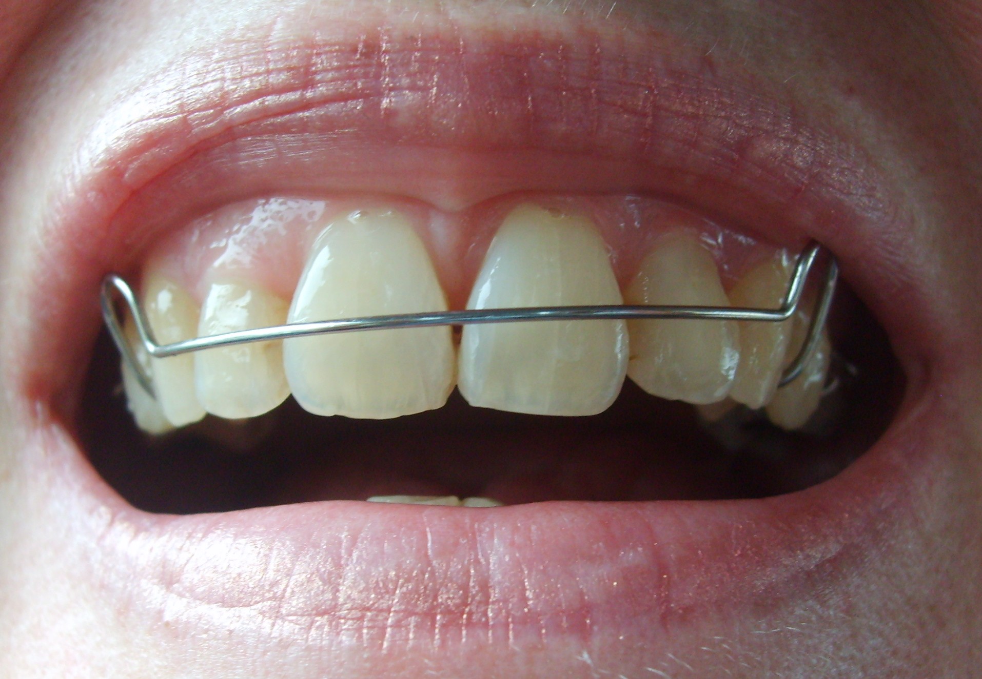 beugel om tanden op hun plaats te houden na vaste beugel | Tandarts.nl ...