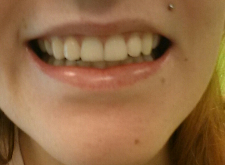 Groeven in tanden | Tandarts.nl Forum