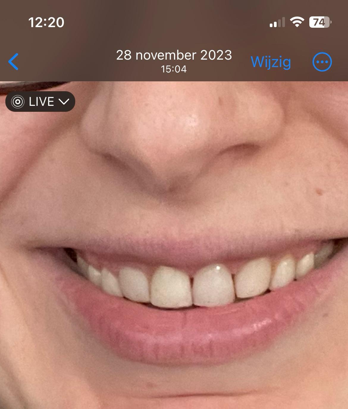 nachtbeugel en/of spalkje | Tandarts.nl Forum