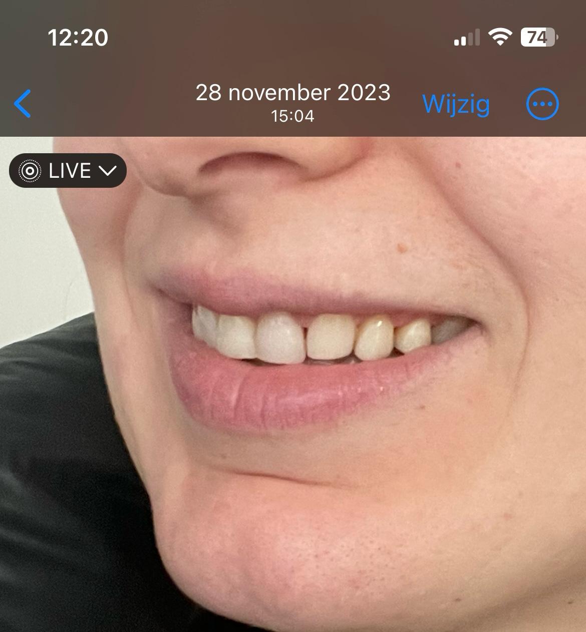 nachtbeugel en/of spalkje | Tandarts.nl Forum