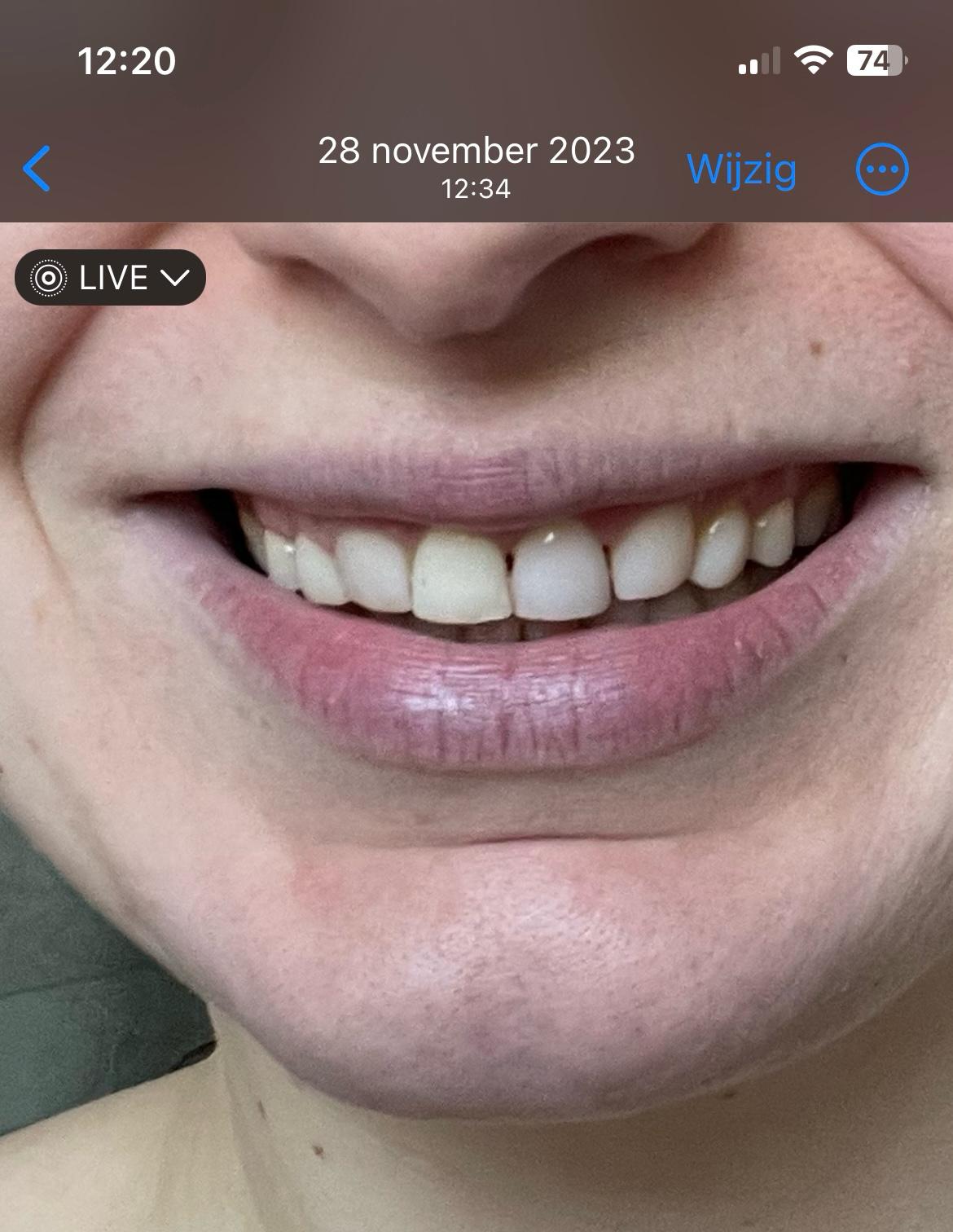 nachtbeugel en/of spalkje | Tandarts.nl Forum